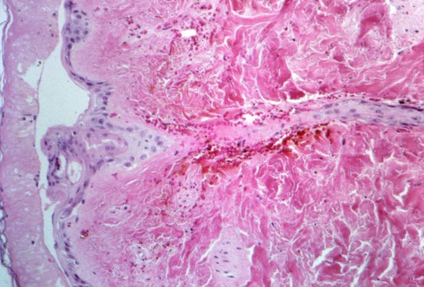 PICT0002 | Coma Induced Bullae | Dr. Ken Hashimoto | Wayne State University SOM - Dermatology ...